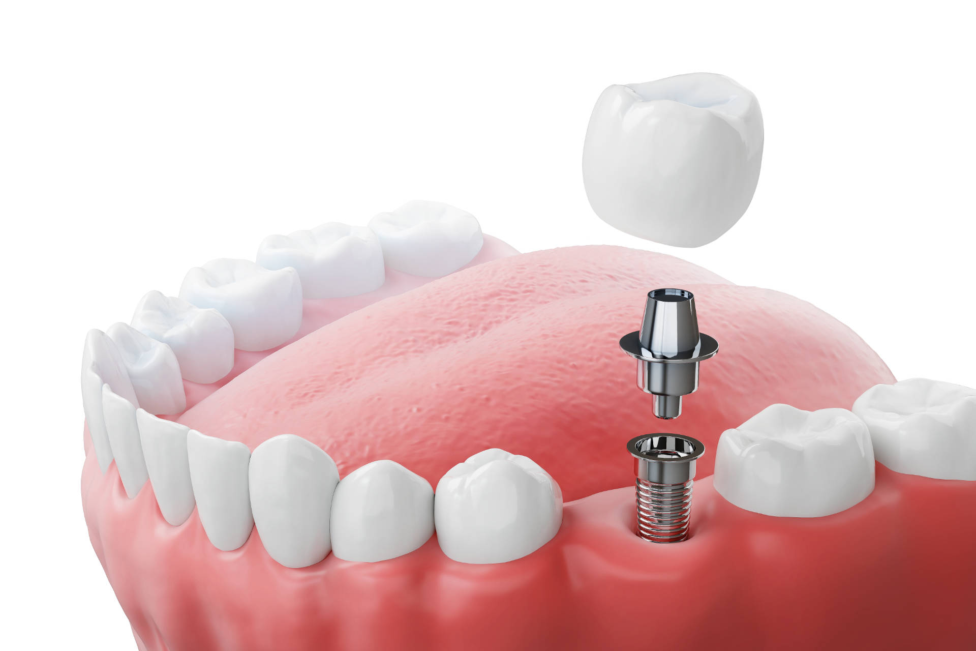 Izguba Enega Zoba: Možnosti Nadomestitve In Estetske Prednosti ...